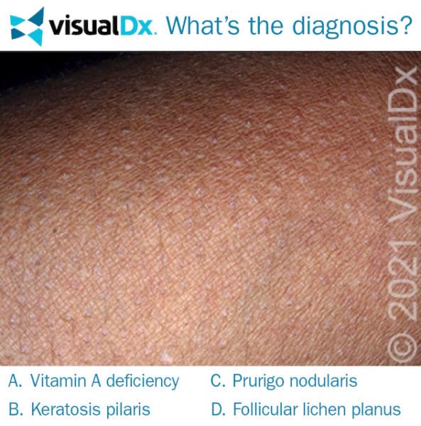 Woman with Widespread Rash and Night Blindness - Let’s Diagnose