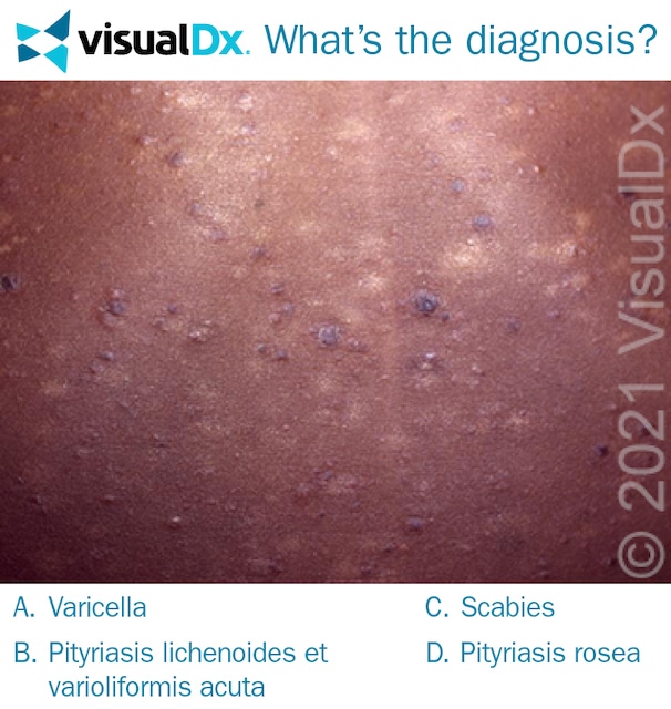 Boy Has Fever, Crusted Lesions on Trunk - Let’s Diagnose