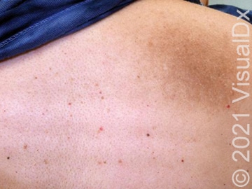 Dermatology Resident Uses Image Collection to Make Diagnosis with ...