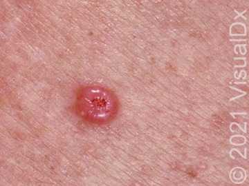 NP Makes Correct Skin Cancer Diagnosis with VisualDx