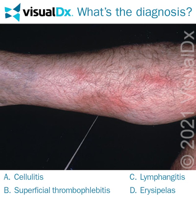 Man Has Blanching Patches on Leg - Let’s Diagnose