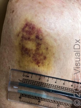 New in VisualDx: Cutaneous Reactions After COVID-19 Vaccination and ...
