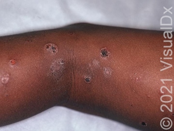 The VisualDx Image Collection Helps Resident Narrow his Diagnosis