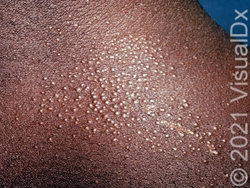 VisualDx Helps Resident Make Better Decisions Daily