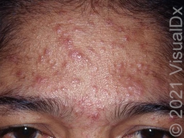 Here Comes the Sun Exposure: Photodermatoses | VisualDx