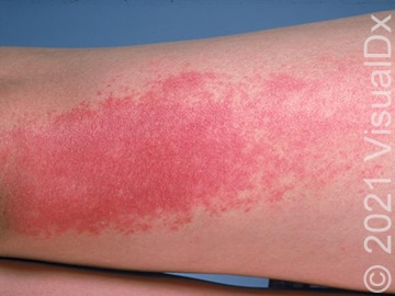 Here Comes the Sun Exposure: Photodermatoses | VisualDx