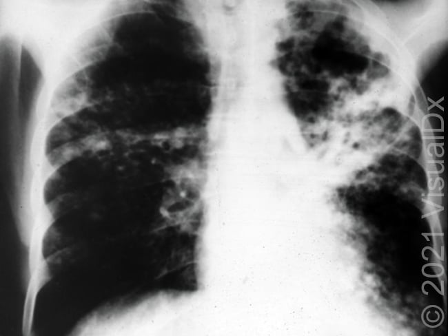 Tuberculosis | VisualDx