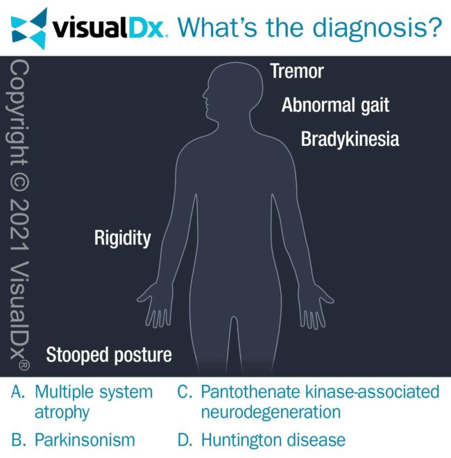 Woman with Rigidity, Tremor, Bradykinesia - Let’s Diagnose
