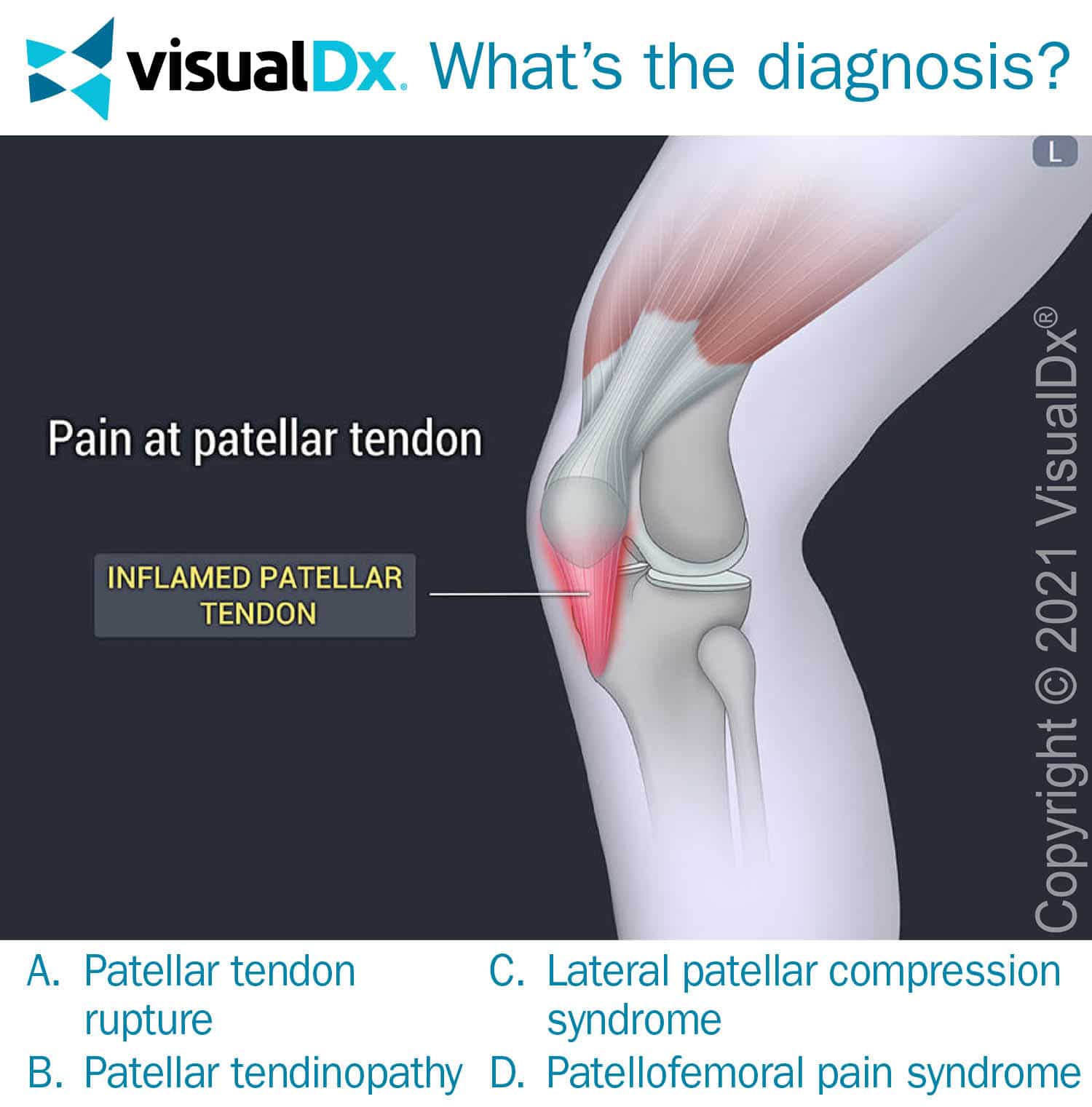Athlete With Patellar Knee Joint Pain - Let’s Diagnose