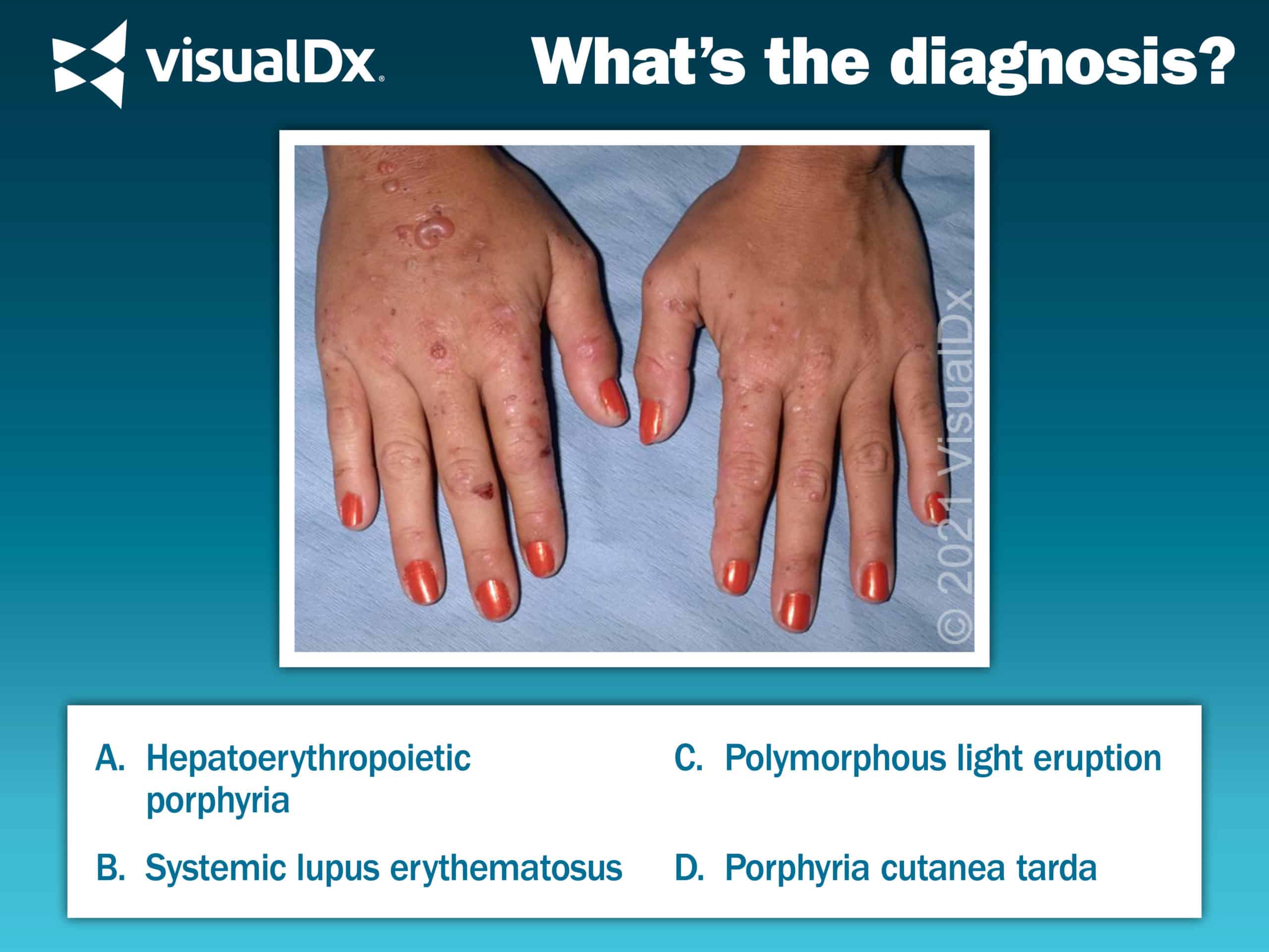 Polymorphous Light Eruption Lupus - Infoupdate.org