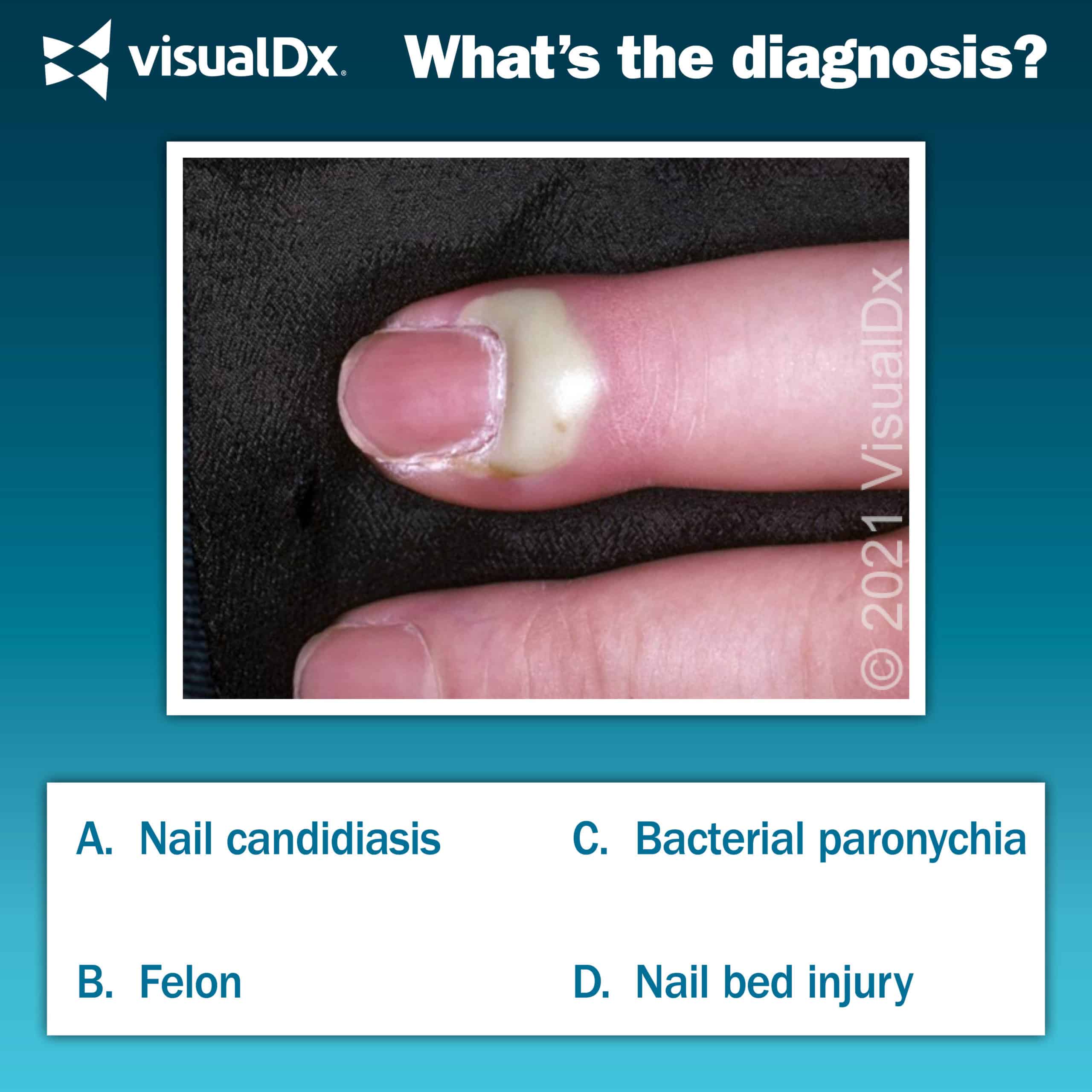 Home Renovator With Pus Near Fingernail - Let’s Diagnose