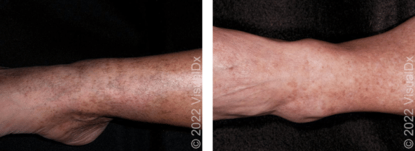 Project IMPACT | Powered by VisualDx