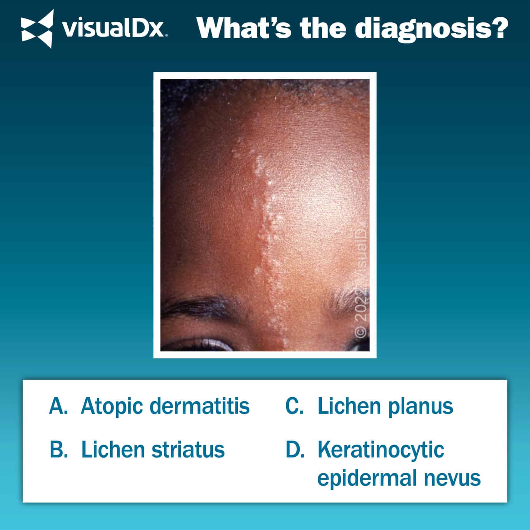 Girl Has Facial Rash With Linear Configuration - Let’s Diagnose