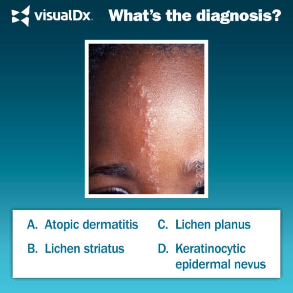Girl Has Facial Rash With Linear Configuration - Let’s Diagnose