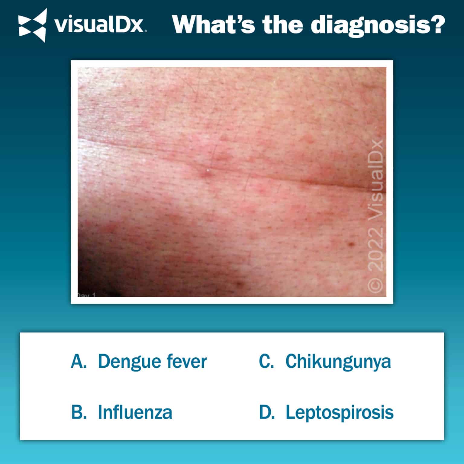 Woman has fever, rash following tropical vacation - Let’s Diagnose