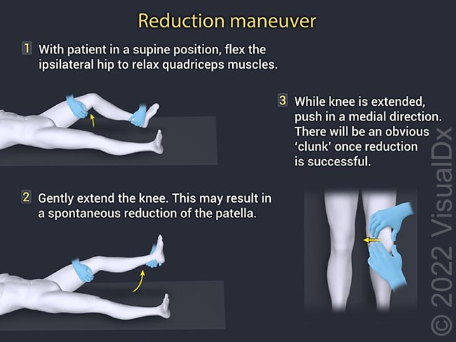 New in VisualDx: Monkeypox updates and illustrated maneuvers