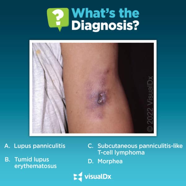 Woman with SLE has painful thigh, arm lesions - Let’s diagnose