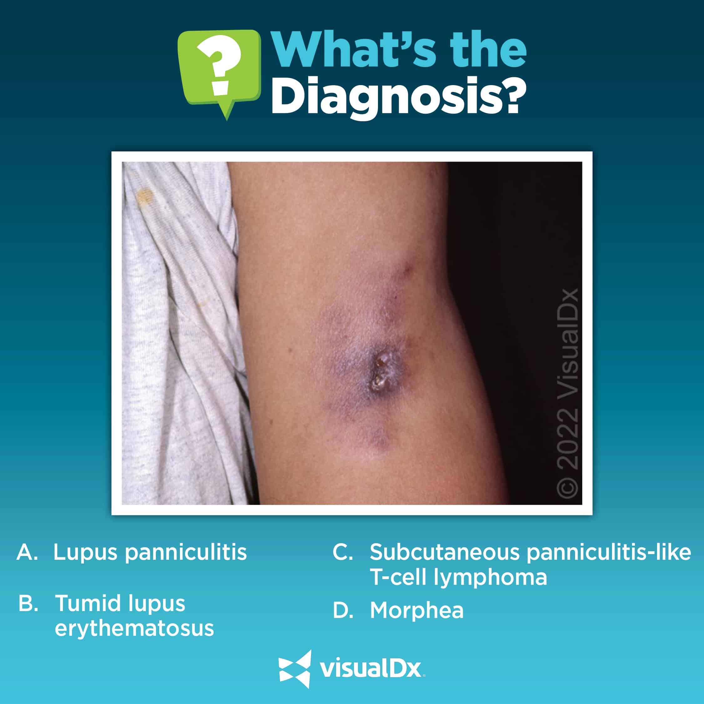 Woman with SLE has painful thigh, arm lesions - Let’s diagnose