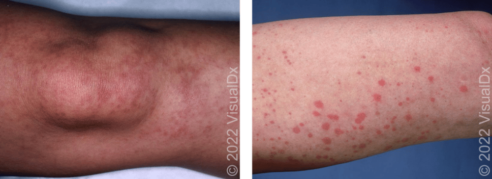 Project IMPACT | Powered by VisualDx