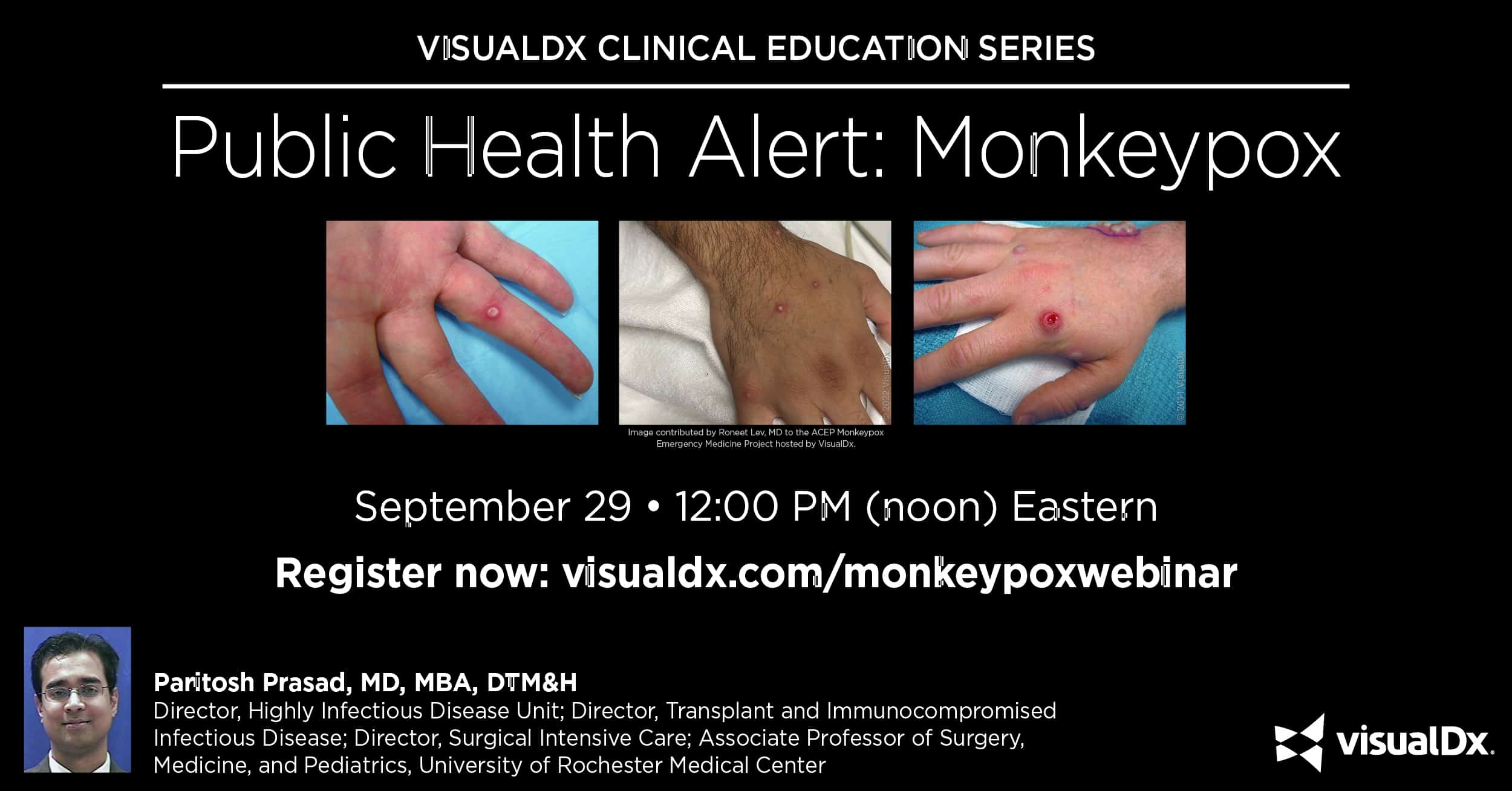 Public Health Alert: Monkeypox | VisualDx