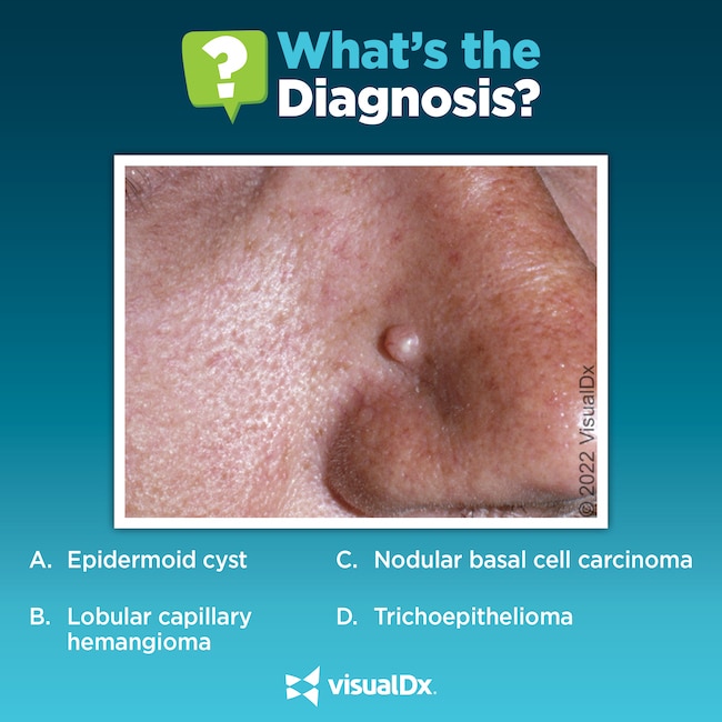 Smooth papule with telangiectasias on lateral nasal sidewall - Let’s ...