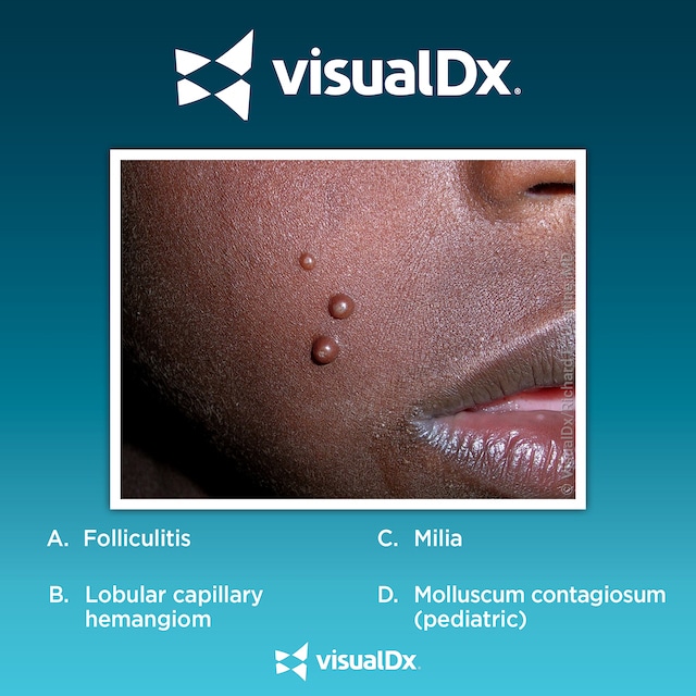 Boy has clusters of umbilicated papules on face - Let’s diagnose | VisualDx