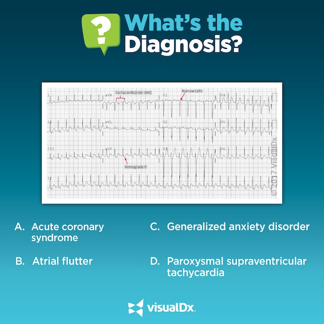Man’s palpitations made worse by morning coffee - Let’s diagnose