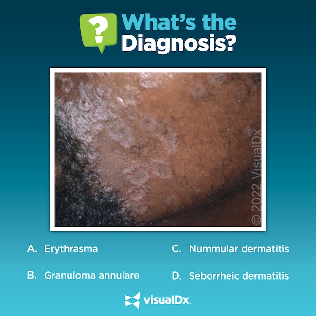 Annular papules and plaques on man’s face. Let’s diagnose. | VisualDx