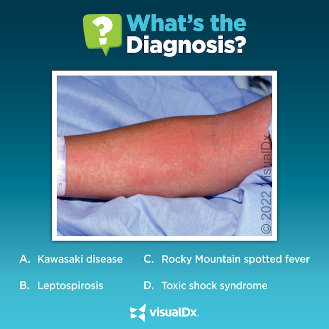 Teen rushed to ER with fever, chills, rash post nasal surgery. Let’s ...