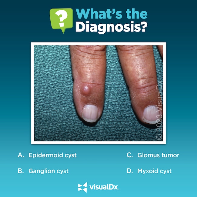 A 65 year-old woman has a smooth, pinkish papule on her index finger ...