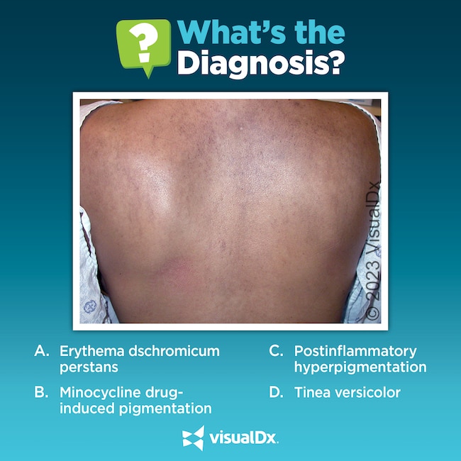 Woman has a 3-month history of back discoloration. Let’s diagnose ...