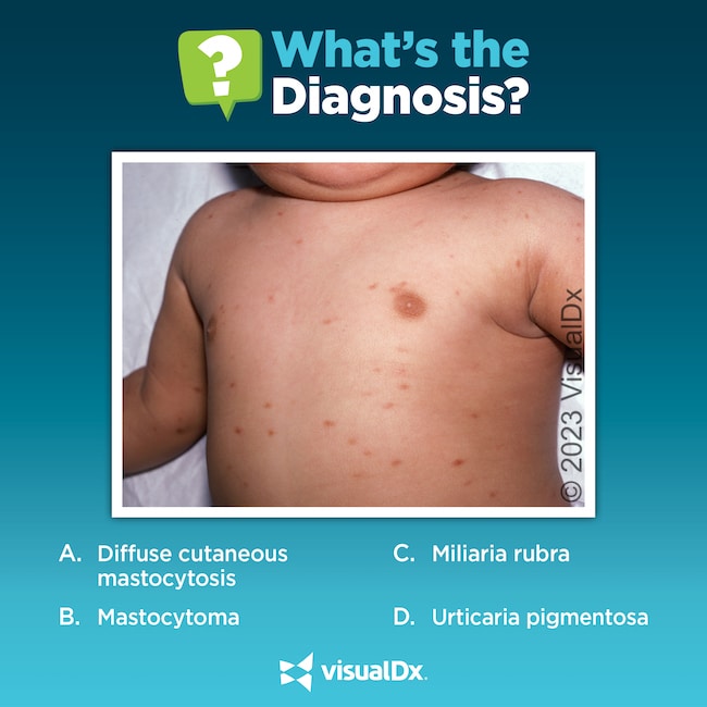 Infant was brought in for a widespread rash. Let’s diagnose. | VisualDx
