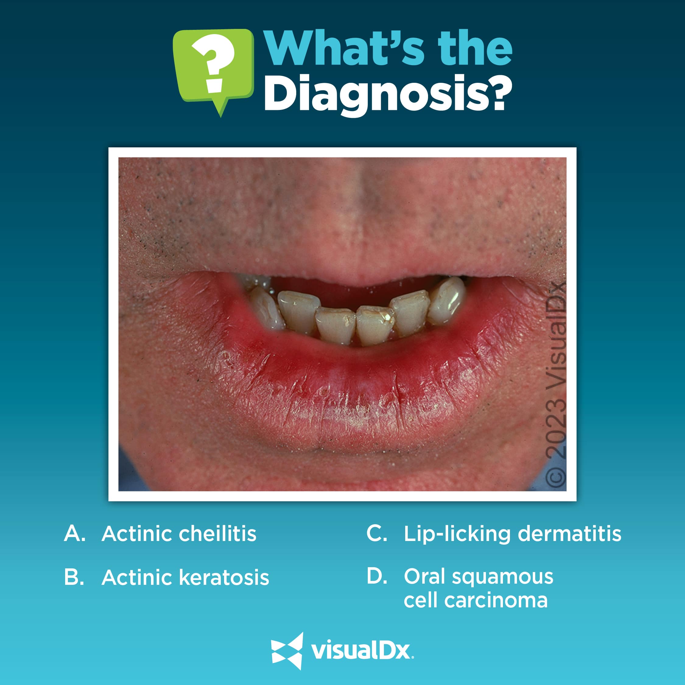 A 50-year-old man has persistent lip dryness and cracking for one month ...