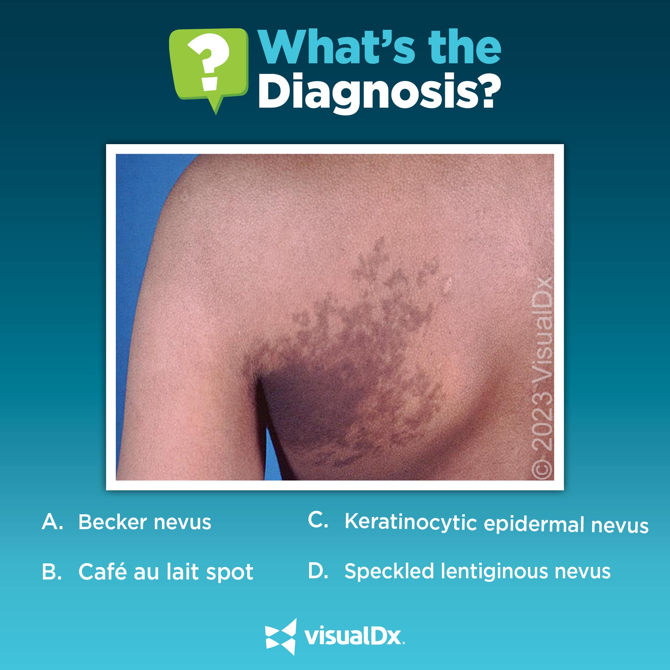 A 16-year-old boy developed a dark brown lesion a few months prior. Let ...