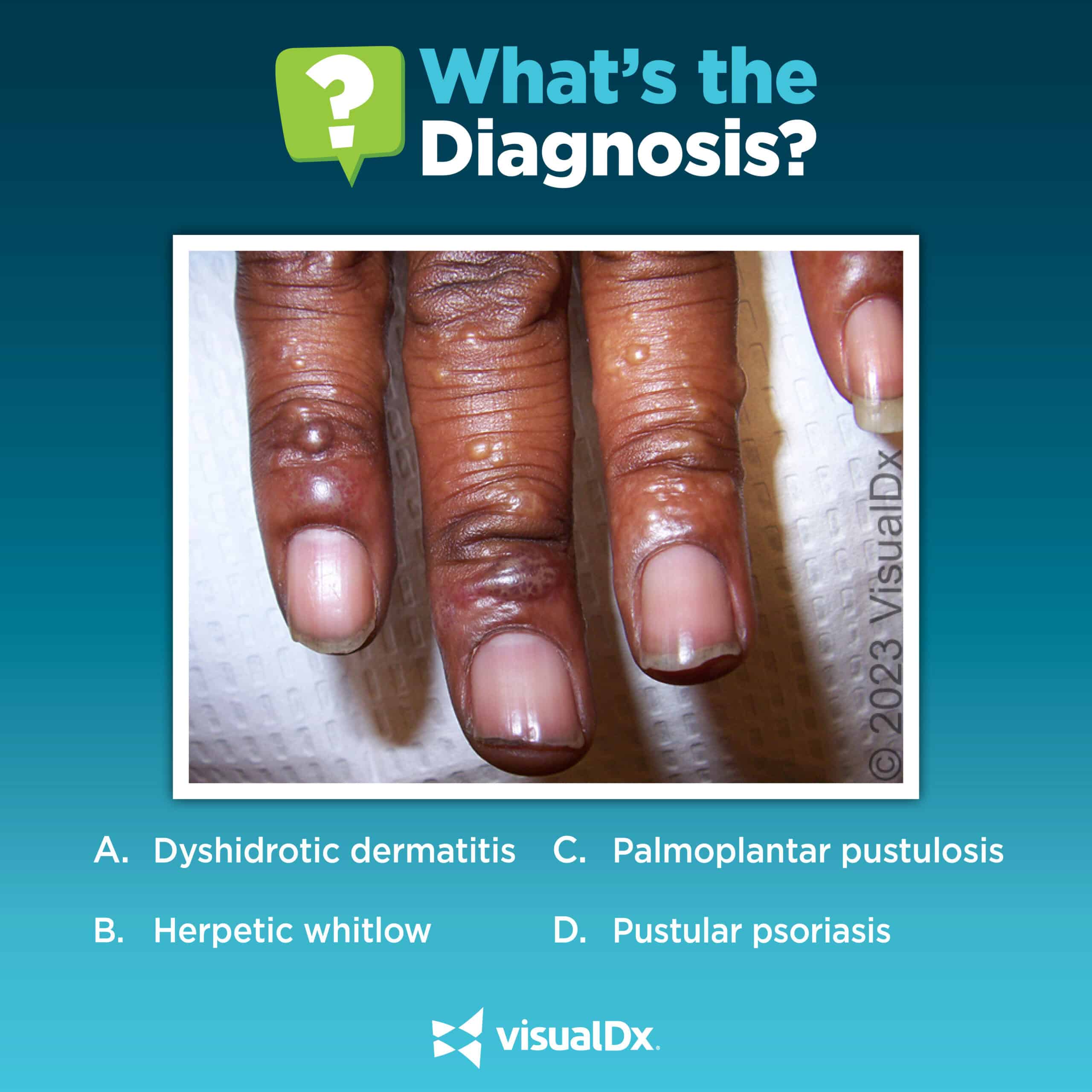 Do you know what’s on this woman’s fingers? | VisualDx