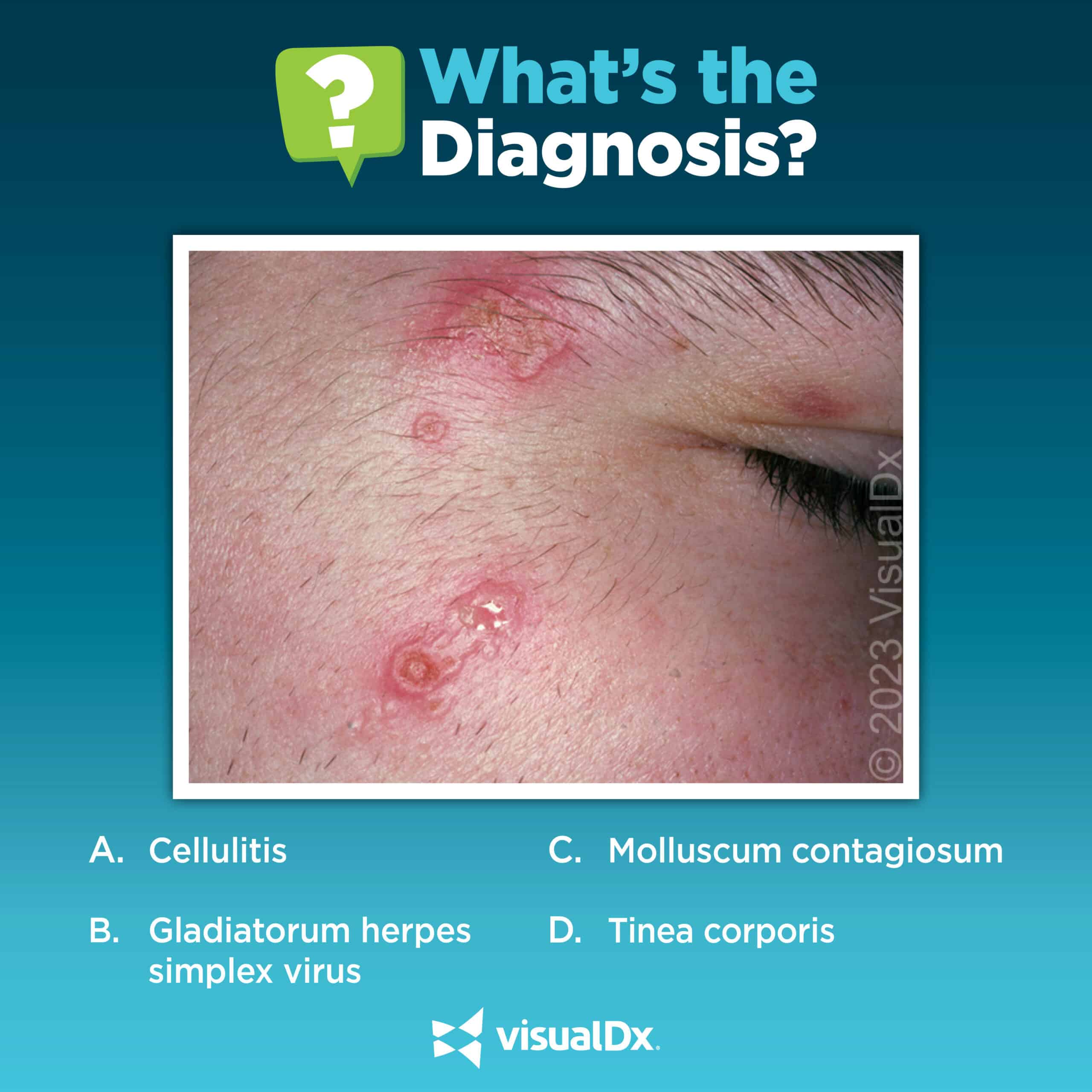 Why are these martial arts students getting facial lesions? | VisualDx