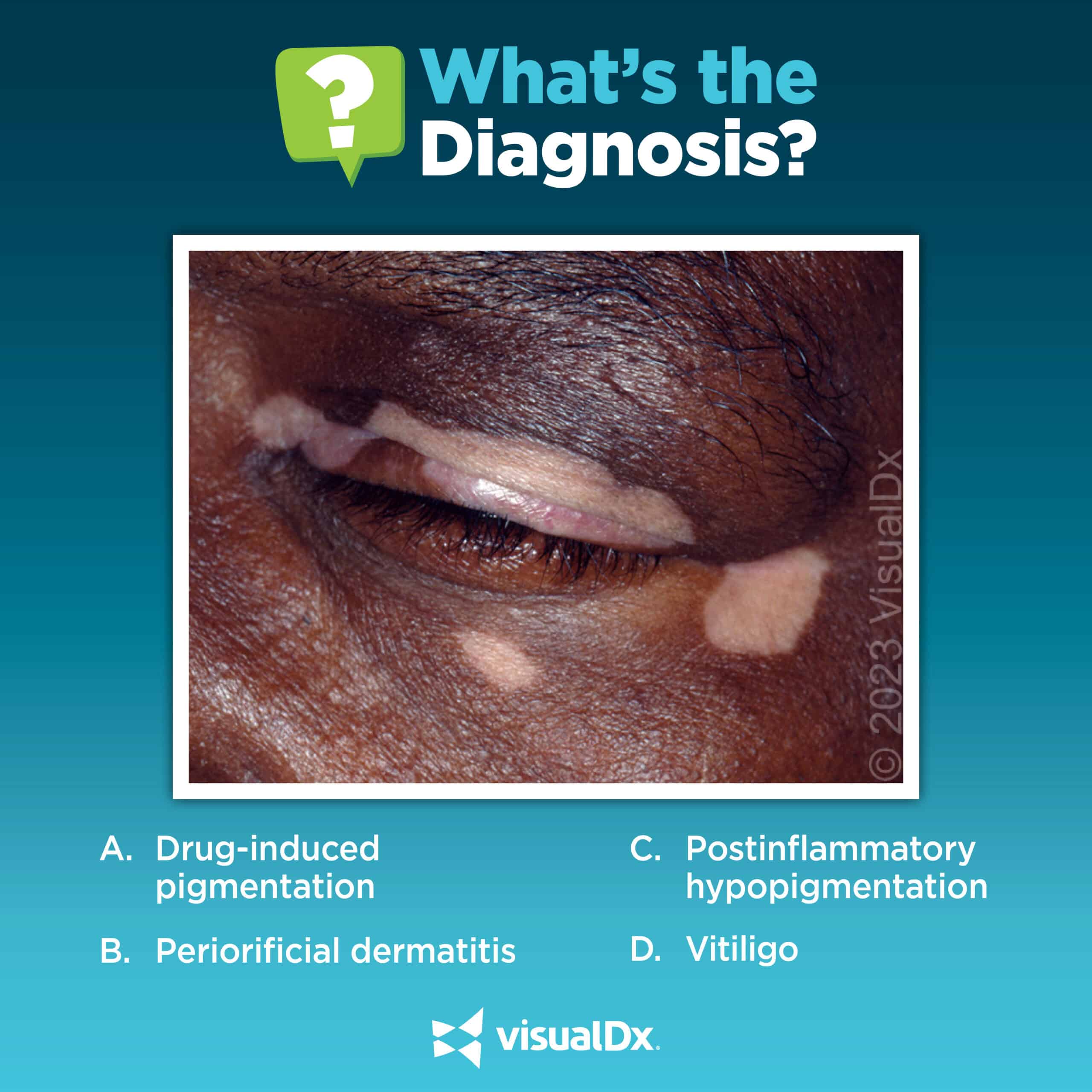 Quiz time! What’s causing the discoloration around the eyes? | VisualDx