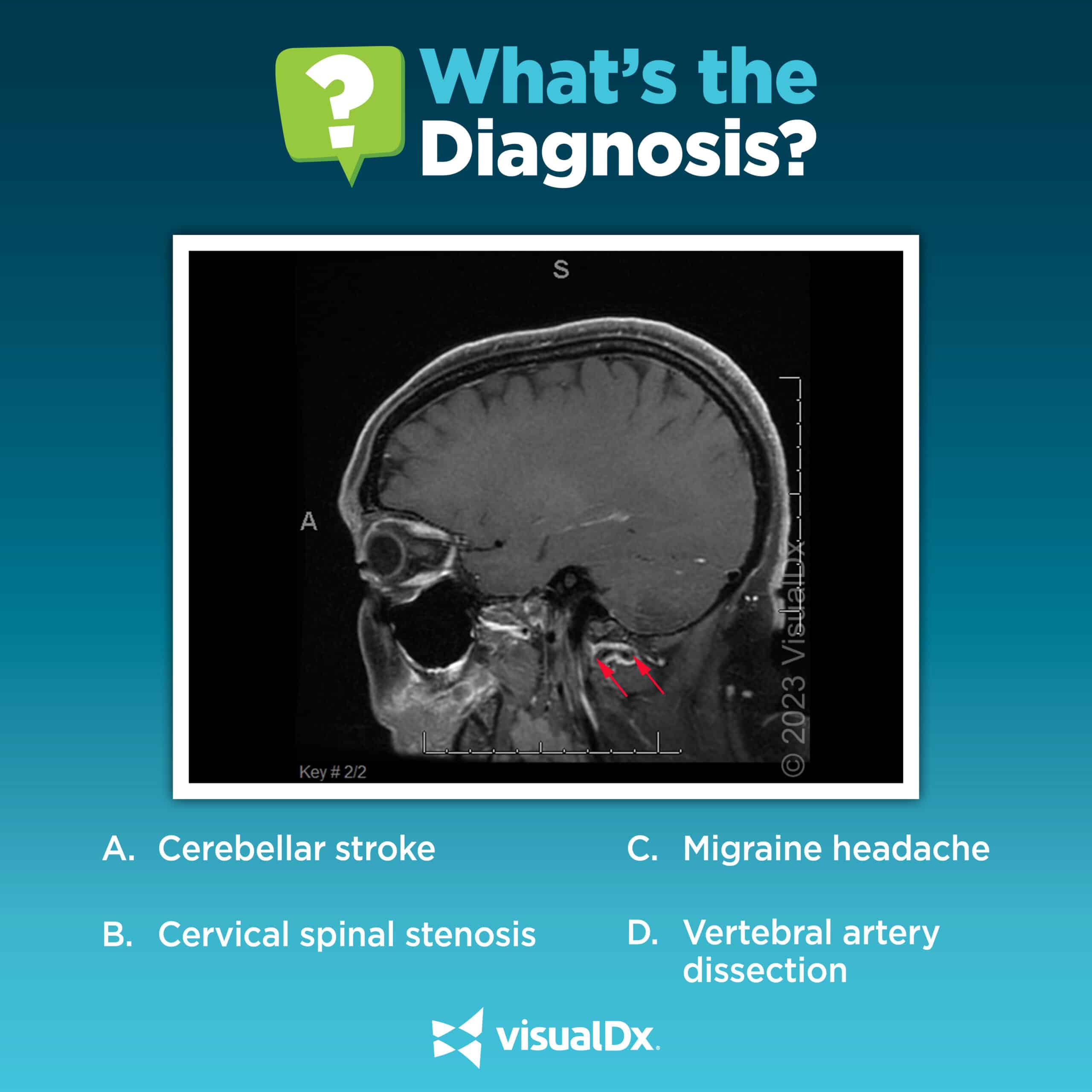 Take the Quiz! Diagnose this patient with unilateral headache, neck ...