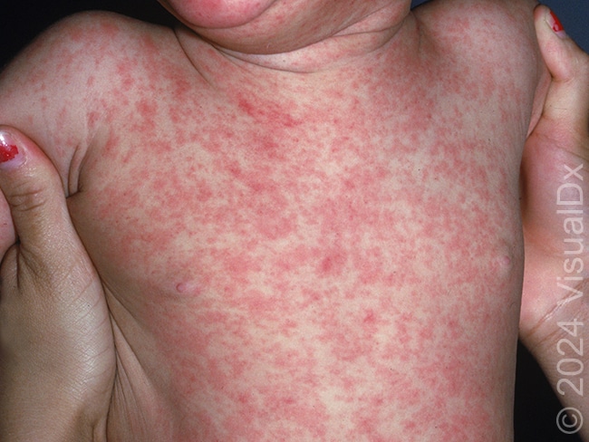 Measles Cases on the Rise: The Importance of Speedy Identification ...