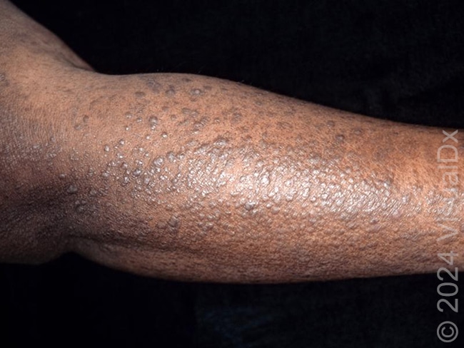 Skin Conditions in Patients Experiencing Homelessness: Atopic ...