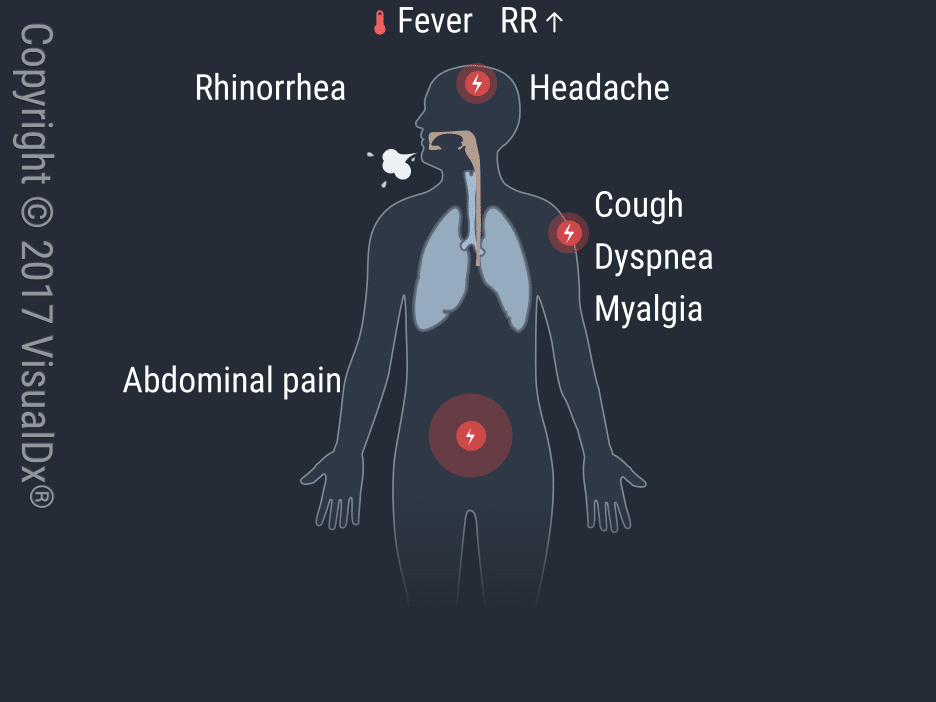 Avian influenza | VisualDx