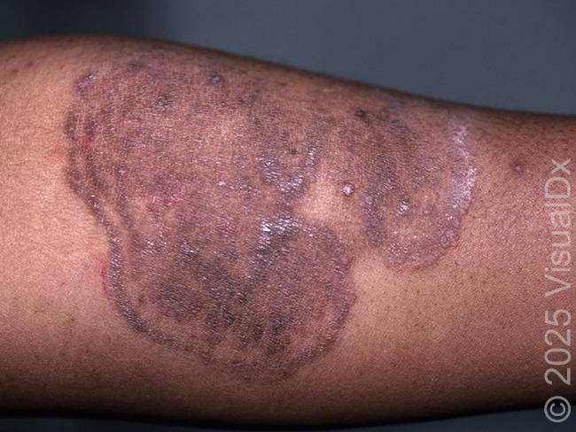 New VisualDx Content Drop: Outbreak Updates, Tinea Images, and More ...